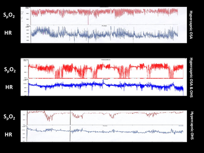 Hypercapnic OSA & OHS Graphs - Novel Ventilation Modes for NIV (AVAPS ...