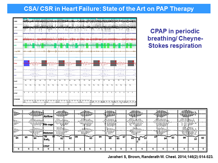 CPAP in Periodic Breathing/ Cheyne-Stokes Respiration - Managing Sleep ...