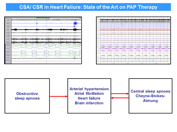 Relationship between Sleep Apnea and Heart Failure - Managing Sleep ...