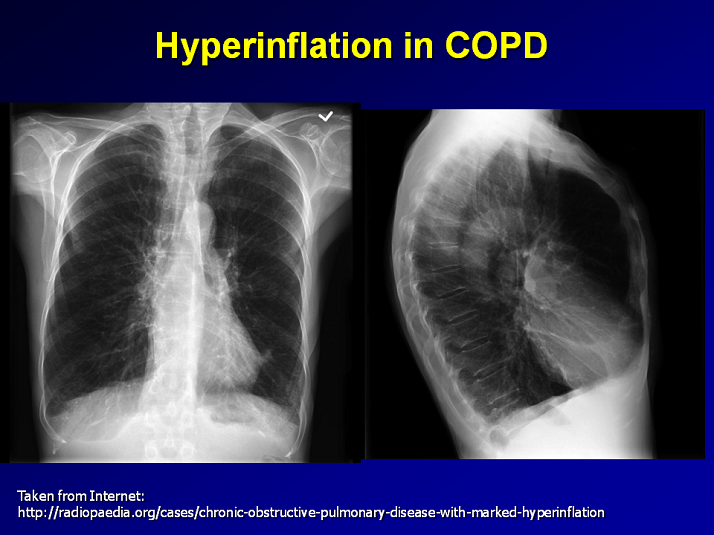 Hyperinflation Chest X Ray