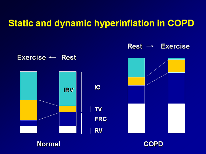 Static and Dynamic Hyperinflation in COPD - Dyspnea in COPD - Activity ...