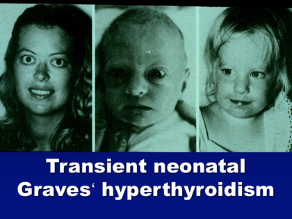 Transient Neonatal Graves Hyperthyroidism - Autoimmune Thyroid Diseases ...