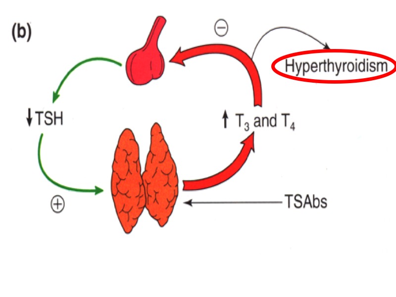Autoimmune Thyroid Diseases