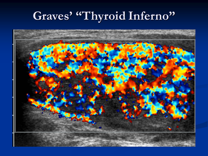 Graves’ “Thyroid Inferno" cont. - Thyrotoxicosis Guideline Update and ...