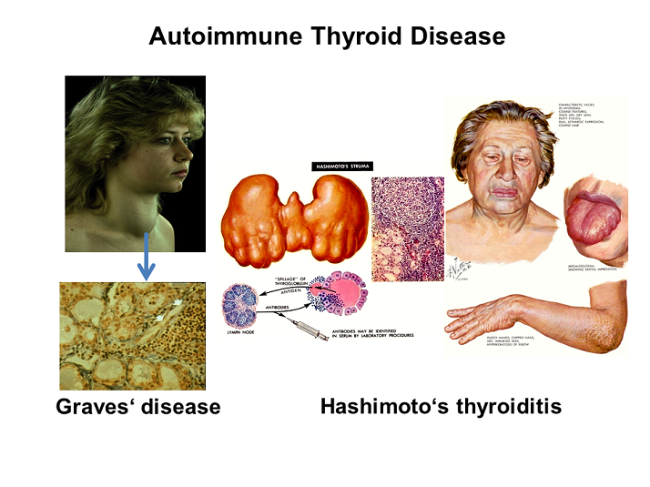 Autoimmune Thyroid Disease - Autoantibodies to the Thyroid-Stimulating ...