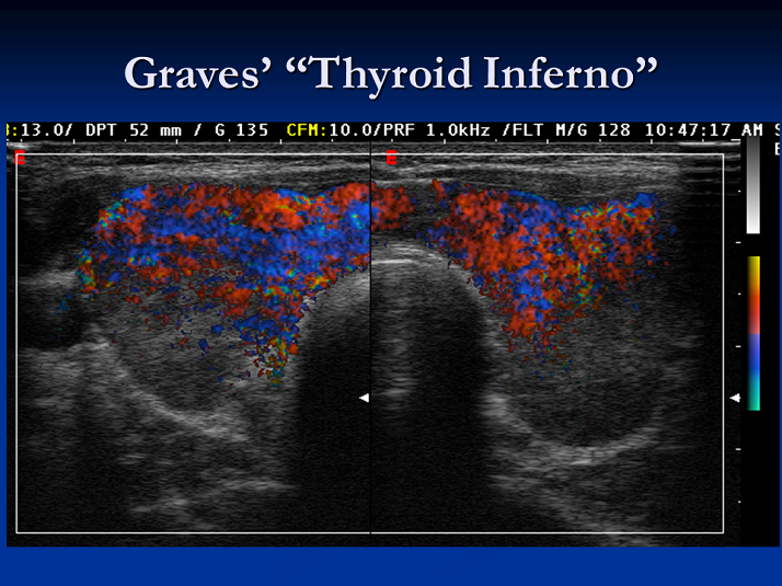 Graves’ “Thyroid Inferno" - Thyrotoxicosis Guideline Update and ...