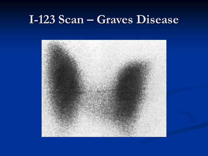 I-123 Scan – Graves Disease - Thyrotoxicosis Guideline Update and ...