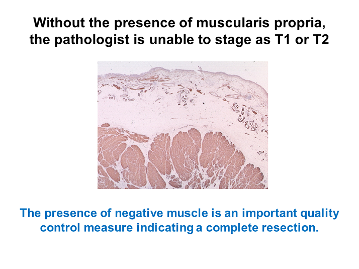 Without the presence of muscularis propria, the pathologist is unable ...