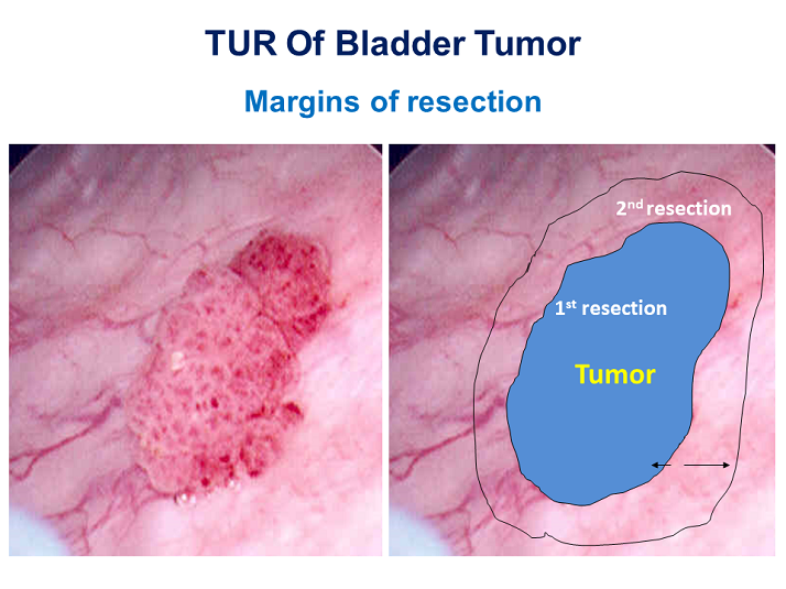 TUR Of Bladder Tumor - Activity Six: Management of T1 High-grade ...