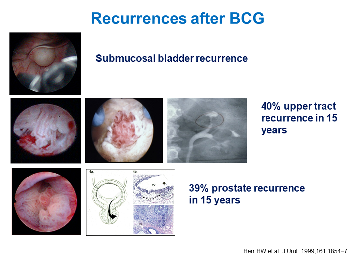 Recurrences After Bcg Activity Six Management Of T1 High Grade