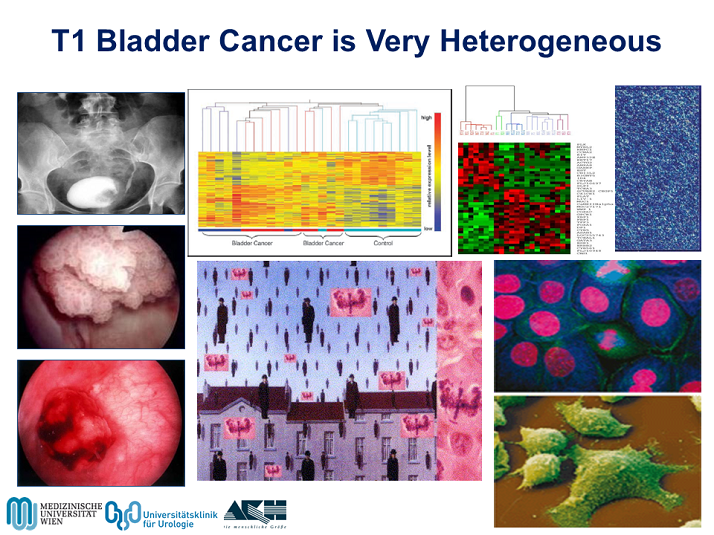 T1 Bladder cancer is very heterogeneous! - Activity Six: Management of ...
