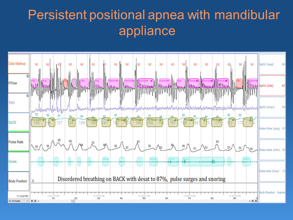 Obstructive Sleep Apnea (OSA) and Positional Obstructive Sleep Apnea (POSA)