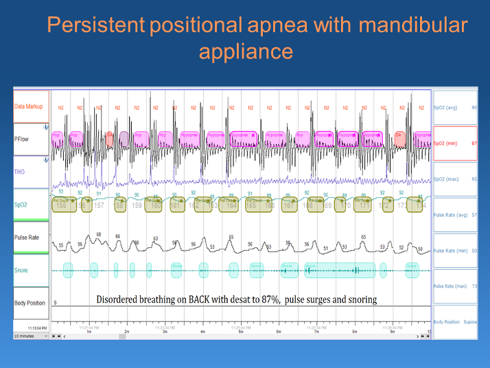 Obstructive Sleep Apnea (OSA) and Positional Obstructive Sleep Apnea (POSA)