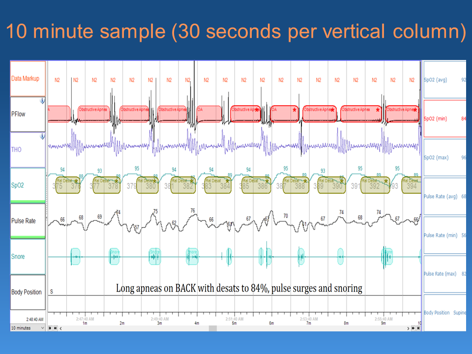Obstructive Sleep Apnea (OSA) and Positional Obstructive Sleep Apnea (POSA)