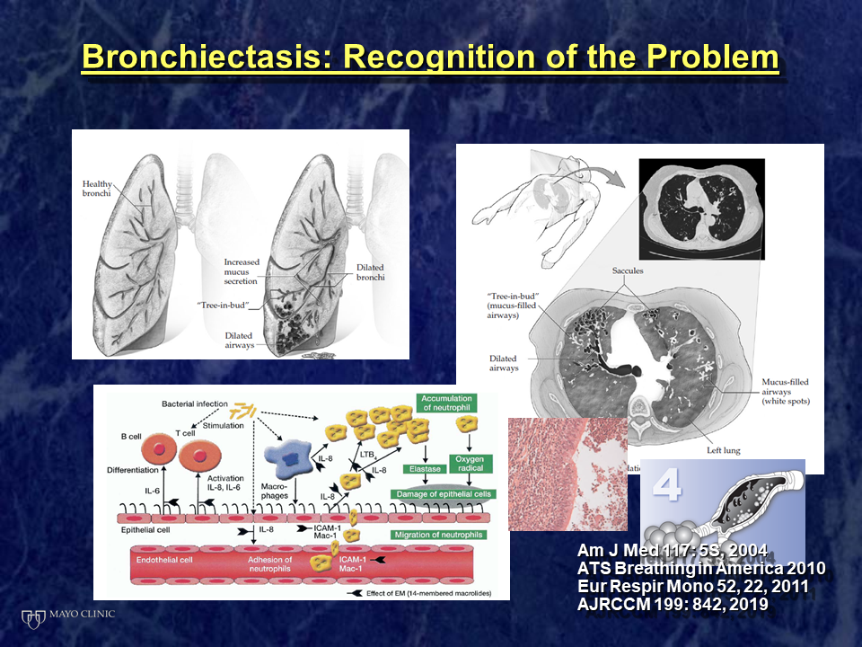 Bronchiectasis: Best Practice and Unmet Needs