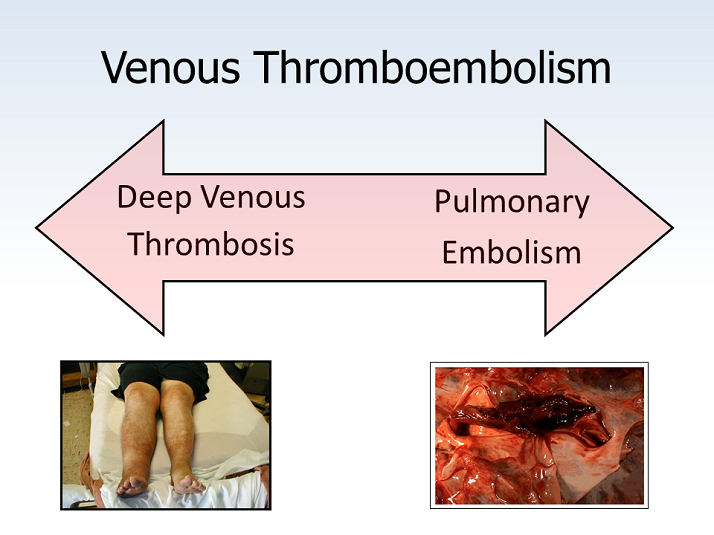 Deep Venous Thrombosis vs Pulmonary Embolism - - D-dimer Testing in ...