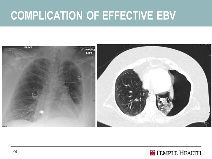 Complication of Effective EBV - Activity One: Bronchoscopic ...