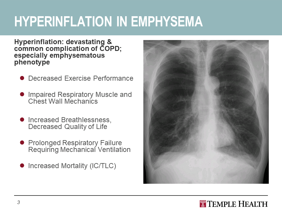Hyperinflation Chest X Ray